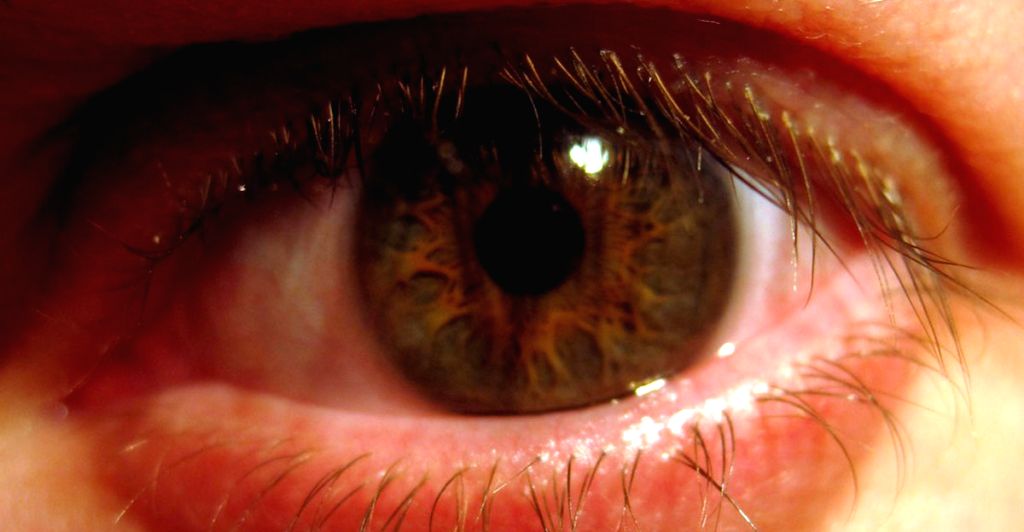 Delhi sees record rise in pink eye, dengue cases, say doctors