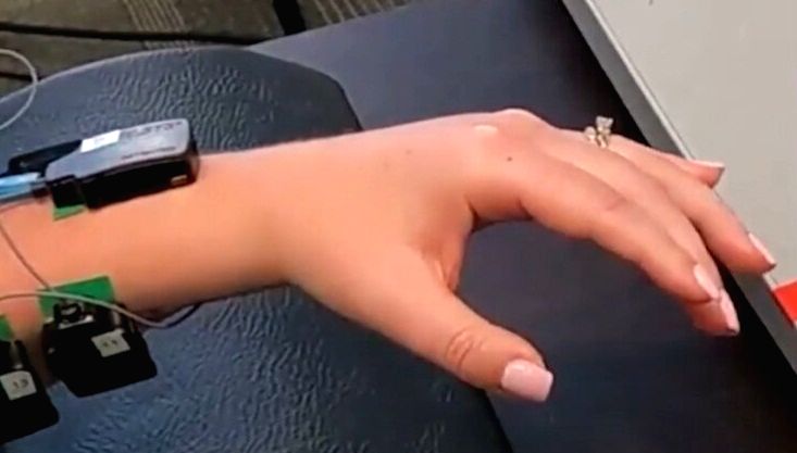 Free photo : Spinal cord stimulation restores arm, hand mobility in ...